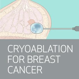 Cryoablation for Breast Cancer | Houston Methodist